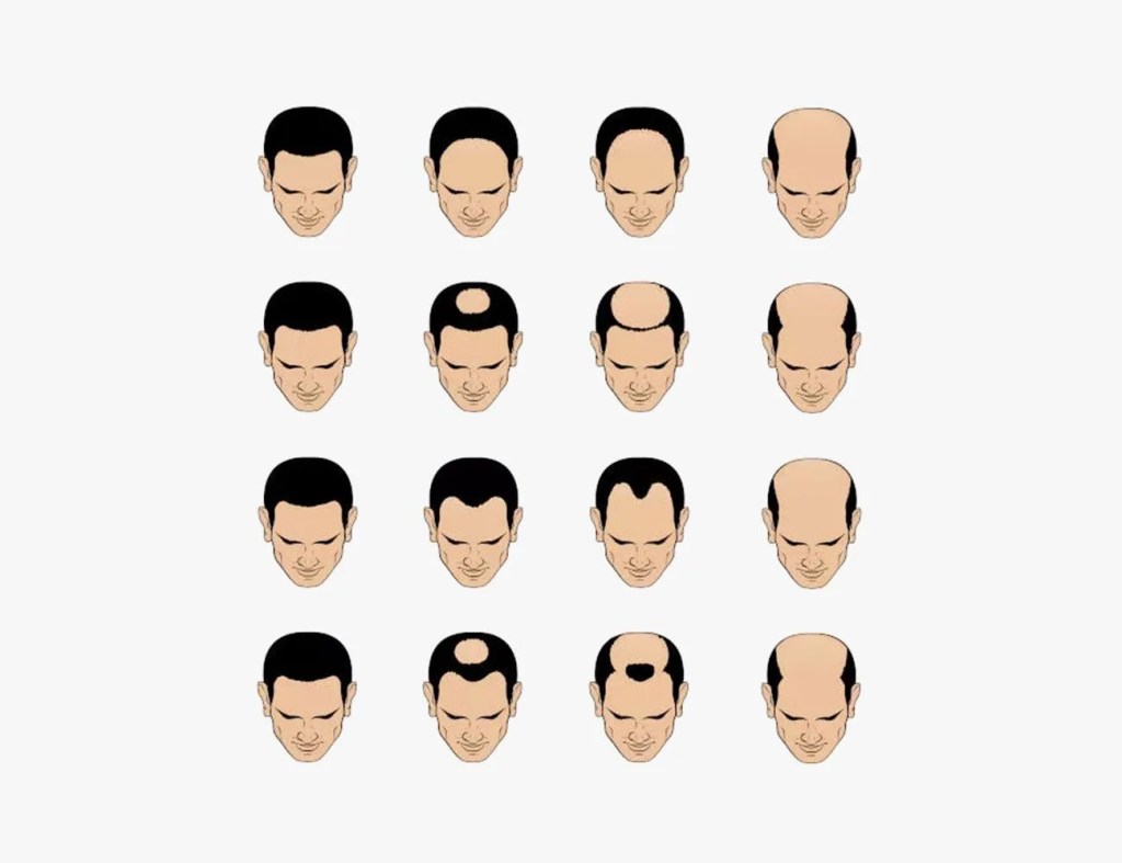 Are You Really Going Bald? A Dermatologist Explains How to Tell | Gear ...